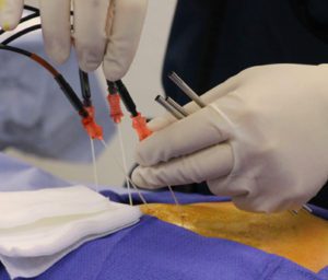 Radiofrequency Nerve Ablation | Advanced Spine & Pain Interventions ...
